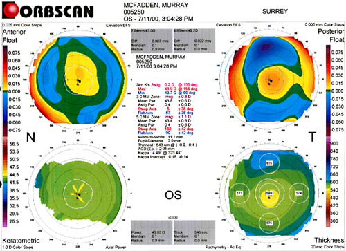 LASIK Laser Eye Surgery - Corneal Topographical Map